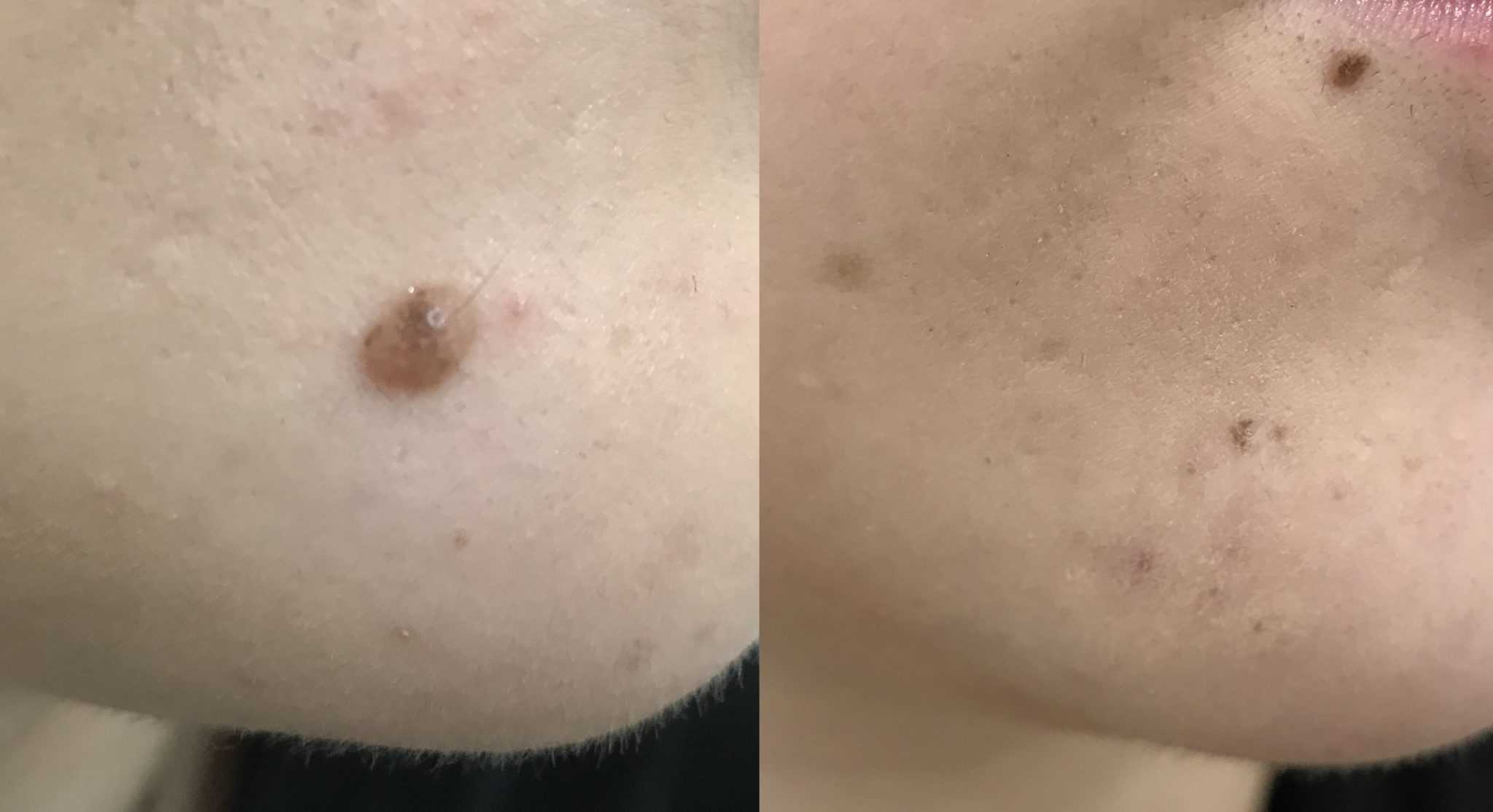 Cosmetic Mole Removal in Adelaide | Skin Doctor SA