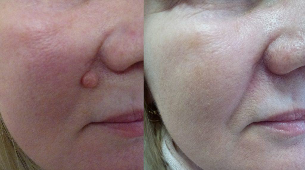 Cosmetic Mole Removal in Adelaide | Skin Doctor SA