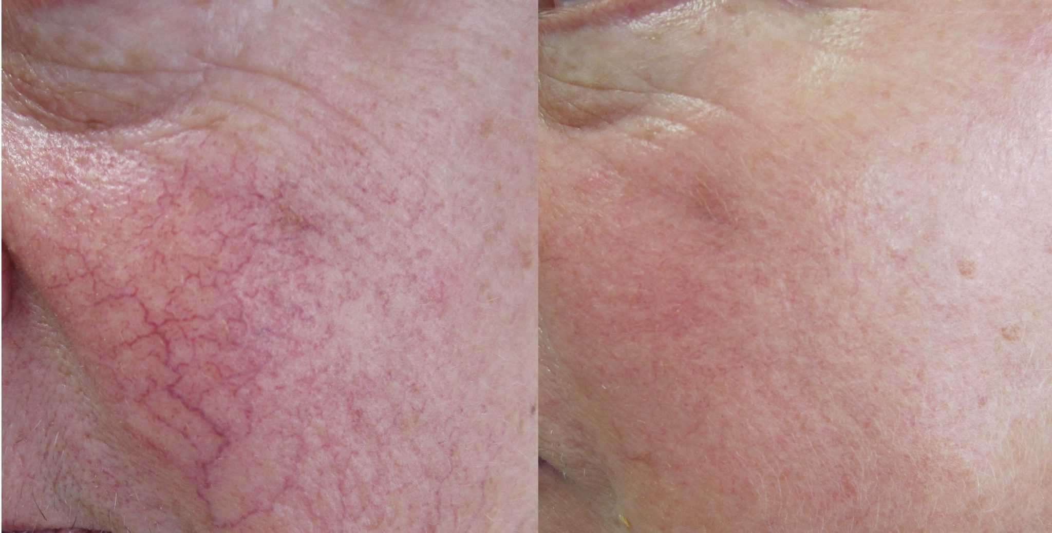 Rosacea & Laser Treatments in Adelaide | Skin Doctor SA