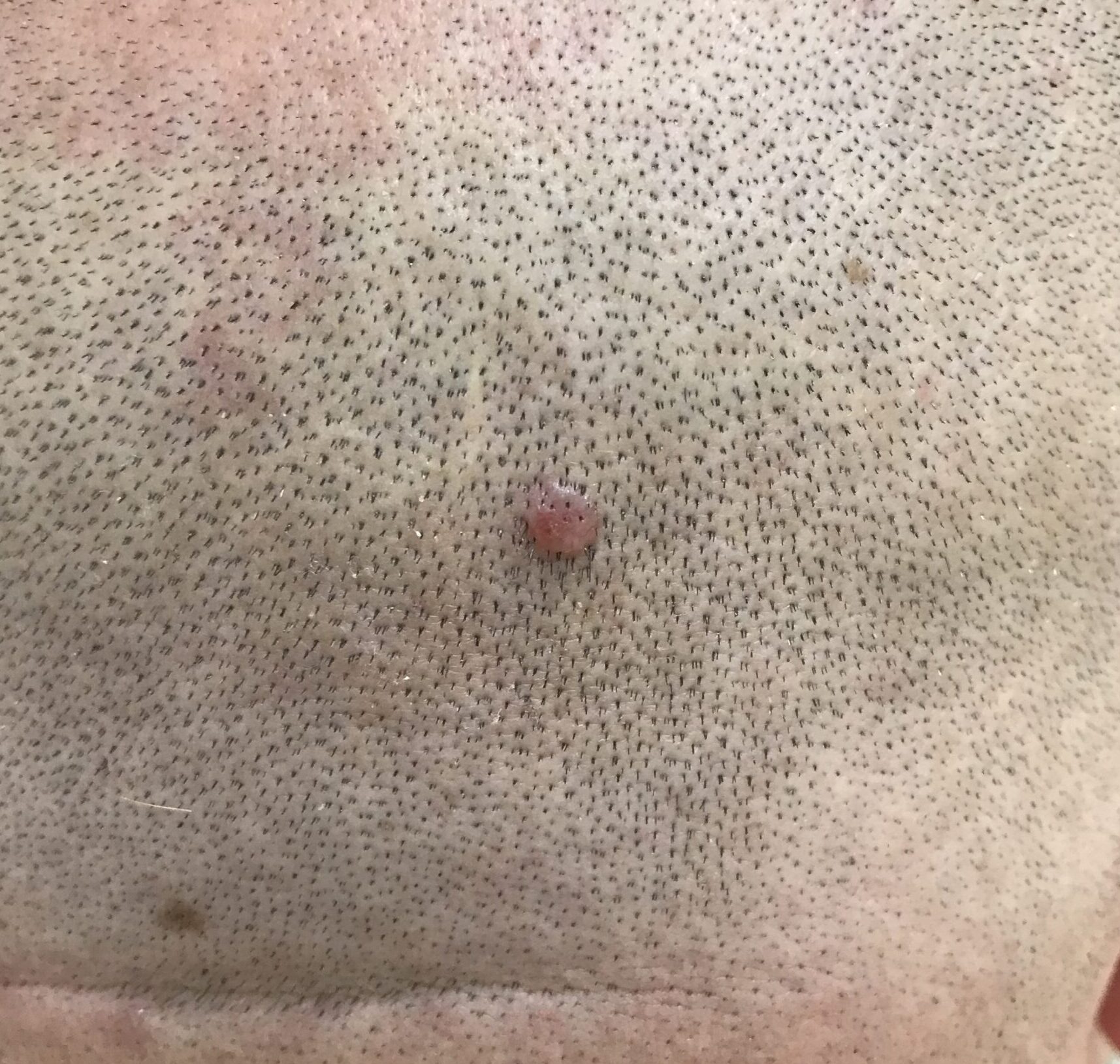 Adelaide Skin Cancer Checks & Mole Removal | Skin Doctor SA